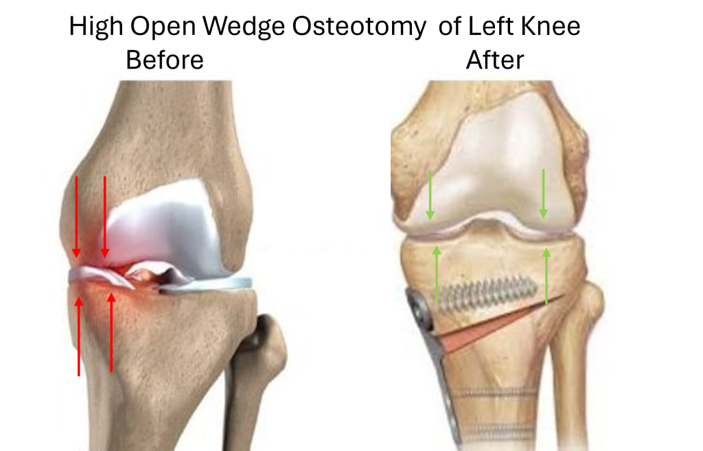 High Tibial Osteotomy (HTO) | Giotikasclinic.com