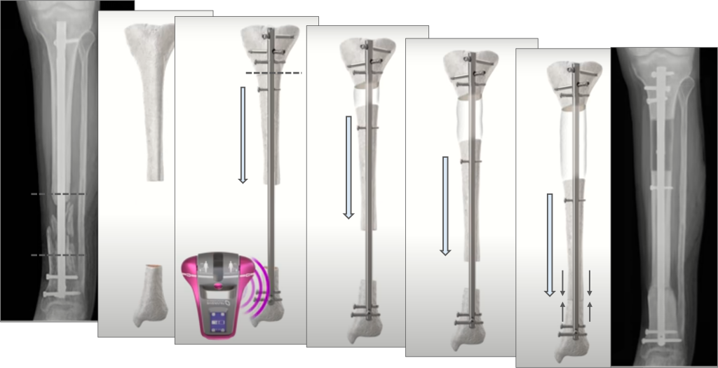 Bone Transport - Giotikas Clinic