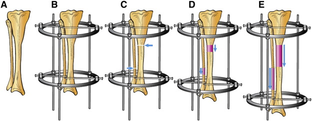 The Principle of Distraction Osteogenesis - Giotikas Clinic
